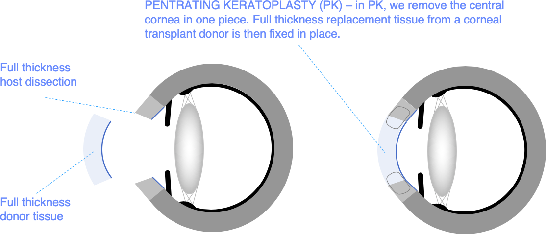 Corneal Transplantation For Keratoconus